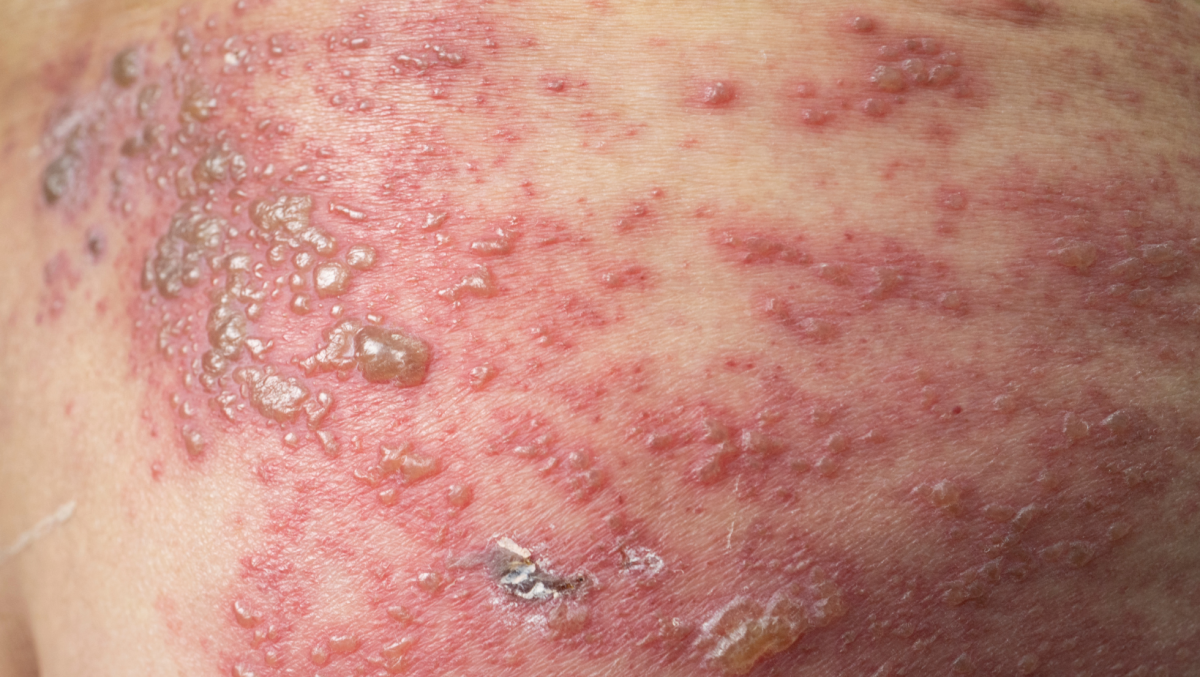 Fuoco di Sant'Antonio: quando preoccuparsi? Sintomi, immagini e cure