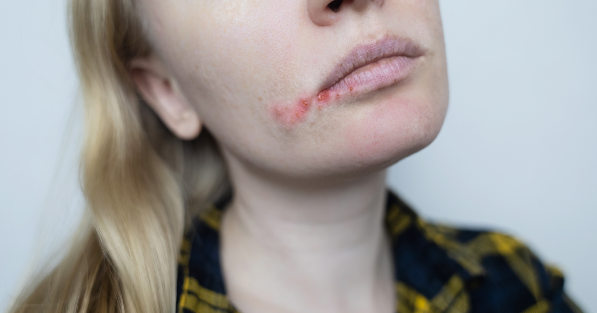 Malattia mani-piedi-bocca negli adulti: sintomi, contagio e cura